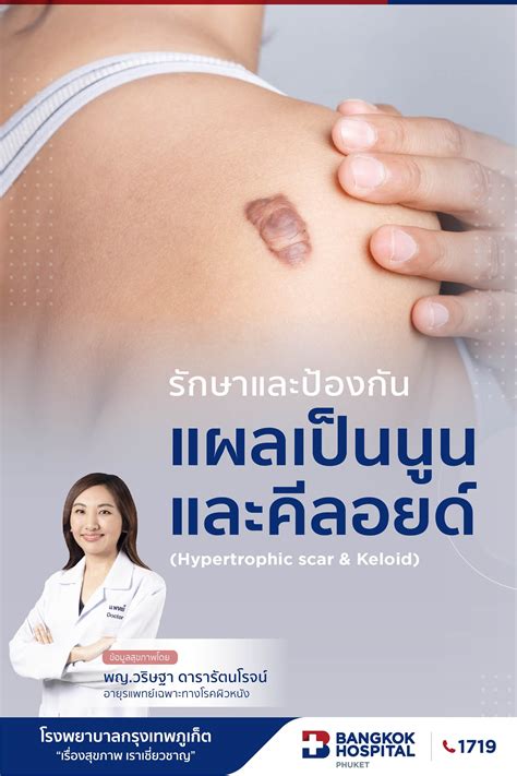 แผลเป็นนูน โรงพยาบาลกรุงเทพภูเก็ต Be Healthy Be Happy Facebook