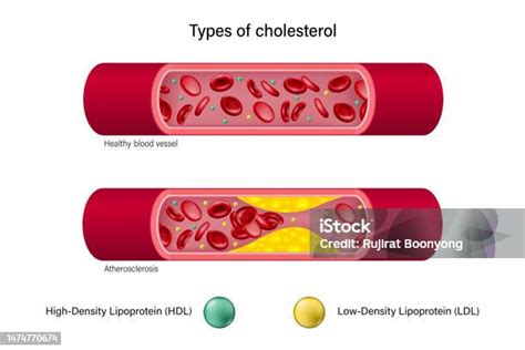 콜레스테롤의 종류 고밀도 지단백질 콜레스테롤에 대한 스톡 벡터 아트 및 기타 이미지 콜레스테롤 동맥 동맥경화 Istock