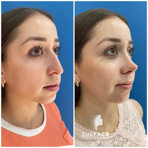 Surface Cirugía Facial Guadalajara