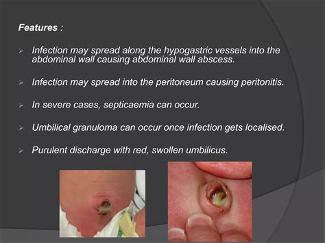 Diseases Of The Umbilicus Pptx