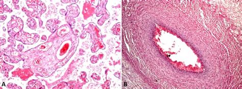 The Procoagulant Status Hypercoagulability As A Risk Factor Of Primary And Secondary