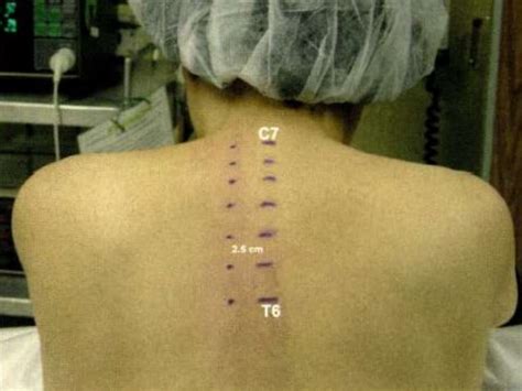 Ultrasound Guided Thoracic Paravertebral Block Pptx