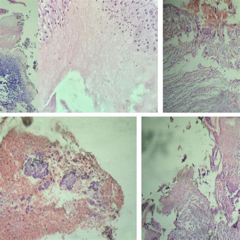 A Basaloid Proliferation Ghost Cells And Multinucleated Giant Cells Download Scientific