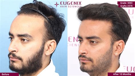 Norwood Scale 2 Baldness Hair Transplant And Treatment Uk