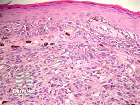 Malignant Melanoma Histology Melanoma Pathology Dermnet Nz