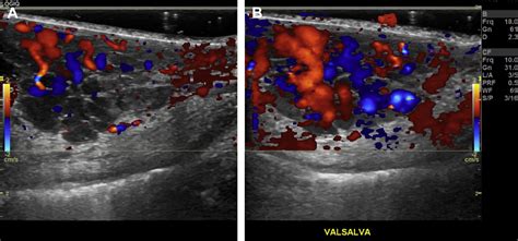Spectrum Of Imaging Manifestations Of Vascular Malformations And Tumors