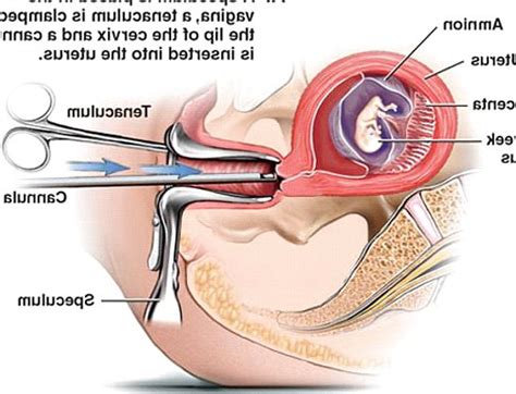 Pregnant Bleeding After Sex