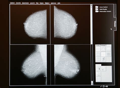 Breast Cancer Awareness Month The Standard Mammogram Is Missing 50