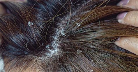 Myth Debunked Dandruff Because Of Dry Scalp