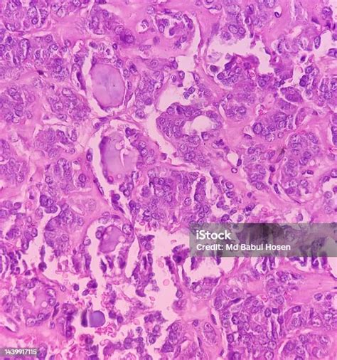 Follicular Adenoma Of Thyroid Gland Light Micrograph Histopathology Of