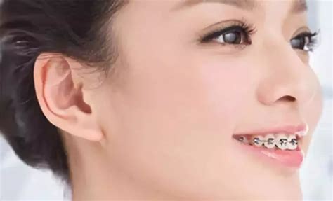 牙齿矫正到底要多少钱？