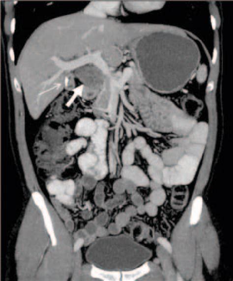 Linfonodos Porta Hepatis Large Lymph Node At The Level Of The Porta