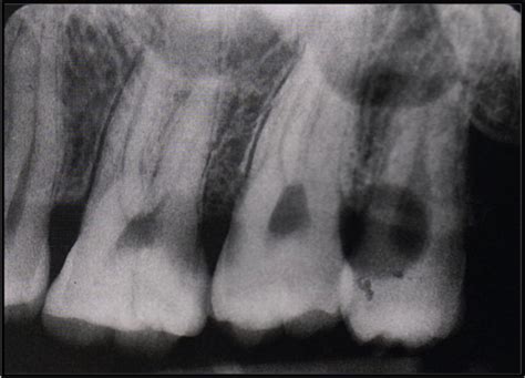 Radiographic Errors Flashcards Quizlet