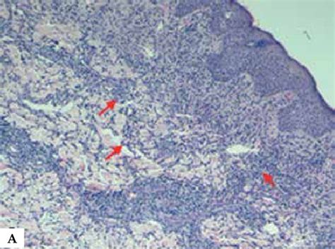 A Hyperplasia Of The Epidermis Perivascular And Interstitial Arrow