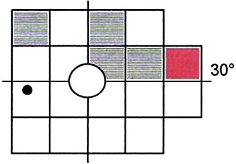 Retinal Nerve Fiber Layer Defect In A Patient With Healthy Neuroretinal Rim Clinics