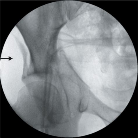 Acetabular Fractures Musculoskeletal Key