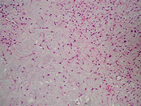 Chondromyxoid Fibroma Pathology Orthobullets