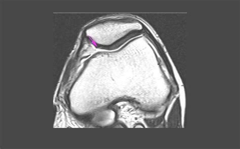 Knee Pain And Chondromalacia Patellae Pro Doctor