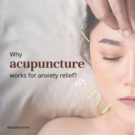 Finally Modern Medicine Recognizing Benefits Of Acupuncture Artofit