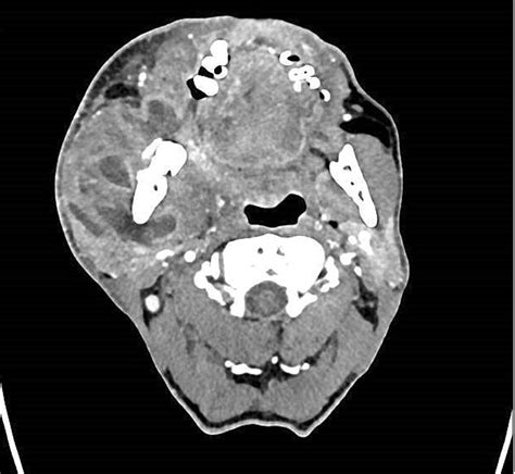 Contrast Enhanced Ct Scan Presenting A Multilocular Abscess Of A Download Scientific Diagram