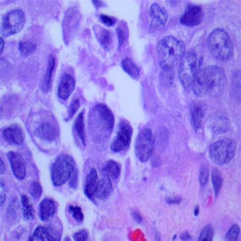 Github Creative Mudassir Lung Cancer Detection