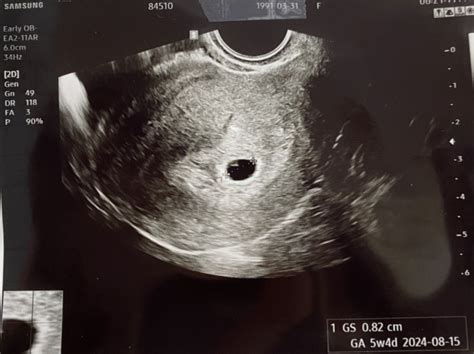 임신 준비 Ep1 임테기 두줄 임신 피검사 수치 질 초음파 아기집 본 후기 엽산 필수 네이버 블로그