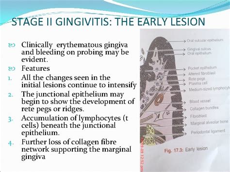 Stages And Clinical Features Of Gingivitis Content Introduction