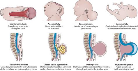 Neural Tube Defects Definition Causes Diagnosis Screening And Treatment