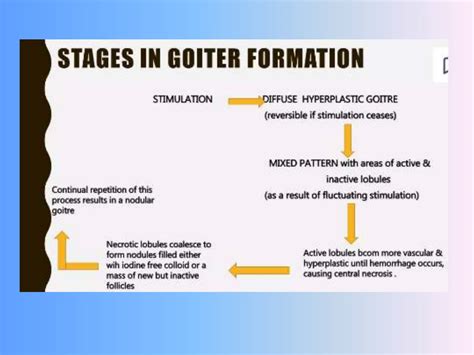 Multi Nodular Goitre Mbbs 3rd Year Pptx