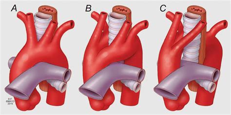 Normal Aortic Anatomy And Variations Of Its Branches Springerlink