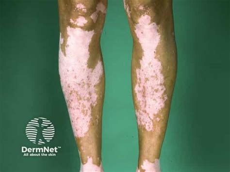 Vitiligo Images — Dermnet