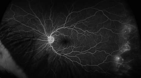 Application Of Fluorescence Angiography At Jenenge Blog