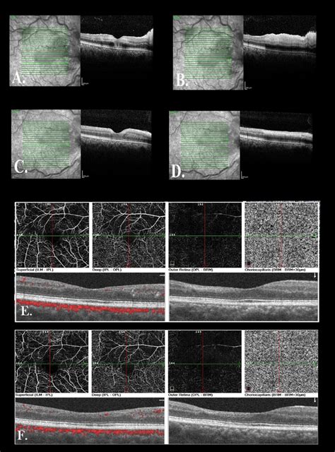 A Spectral Domain Optical Coherence Tomography Sd Oct Of The Right