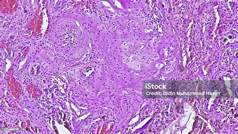 Histology Of Cavernous Hemangioma In The Right Frontal Temporal