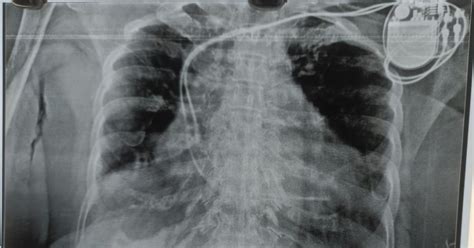 Radiographicgyan Mri For A Patient With A Cardiac Pacemaker While