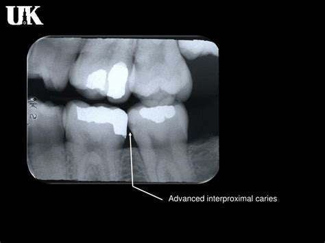 Ppt Radiology Of Caries Powerpoint Presentation Free Download Id2029144