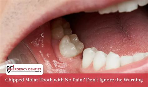 Chipped Molar Tooth With No Pain Dont Ignore The Warning
