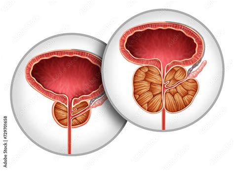 Enlarged Prostate Organ Gland As Benign Prostatic Hyperplasia As A