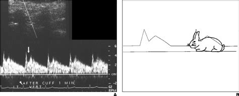 Figure 16 From A Spectrum Of Doppler Waveforms In The Carotid And