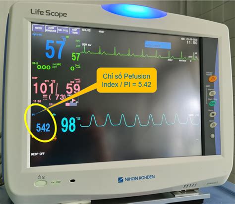 PI Perfusion Index Minh Hùng Nguyễn