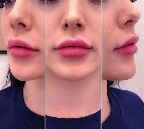Botox Lips