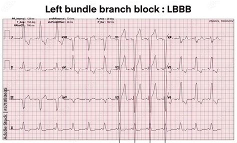 Electrocardiogram Show Left Bundle Branch Block Lbbb Heart Beat Cpr Ecg Ekg Vital Sign