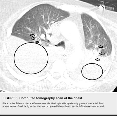 Figure 3 From A Case Of Plasmablastic Multiple Myeloma With Extramedullary Disease Manifesting