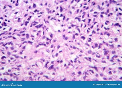 Photomicrograph Of An Astrocytoma A Type Of Brain Tumor Under The Microscope Stock Image