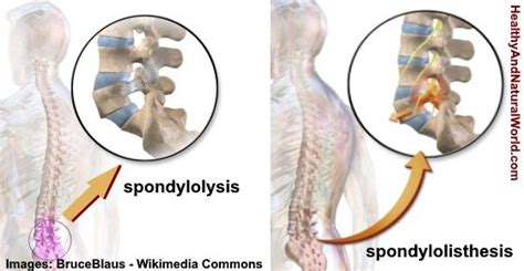 What Is Pars Defect Mapageprek