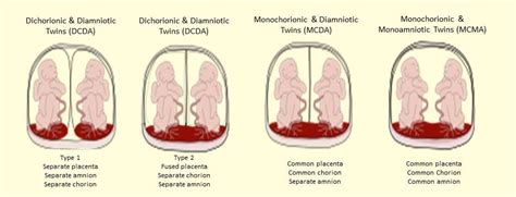 Different Types Of Identical Twins
