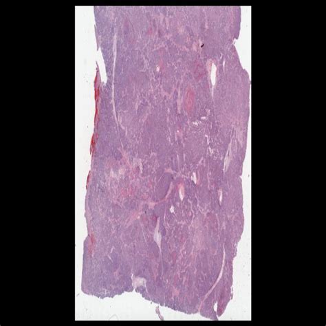 Ovarian Cancer 3 Semantic Segmentation Dataset And Pre Trained Model By Data6000 Capstone