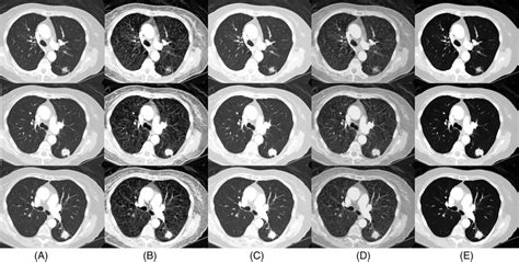 Comparison Of Lung Ct Foreground A Original Images B Gaahe C Download Scientific