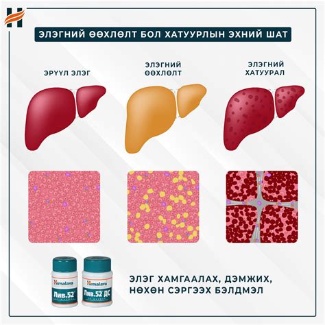 Архи уудаггүй ч элэг өөхөлдөг “ЦАХИУР ТӨМӨР” ХХК