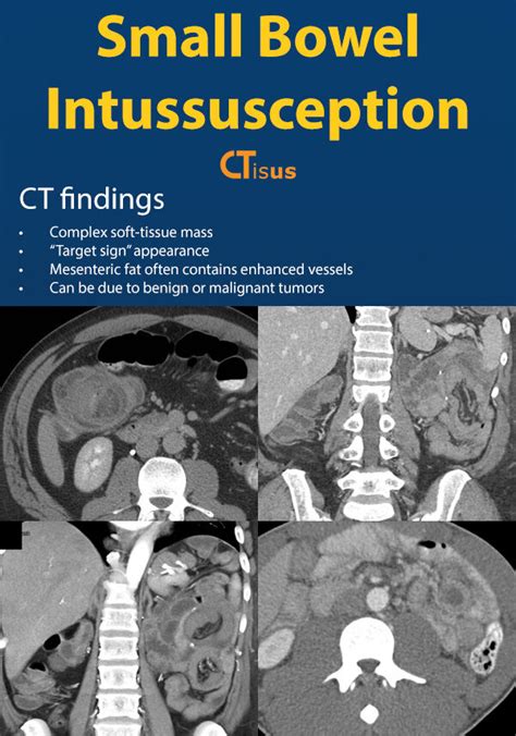 Small Bowel Intussusception Ct Findings Ga4ppisk Ctisus
